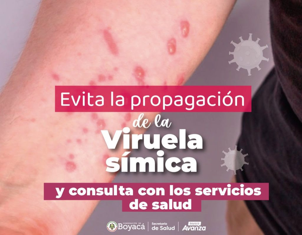 Fue confirmado el primer caso de viruela símica en Boyacá – Noticias en ...